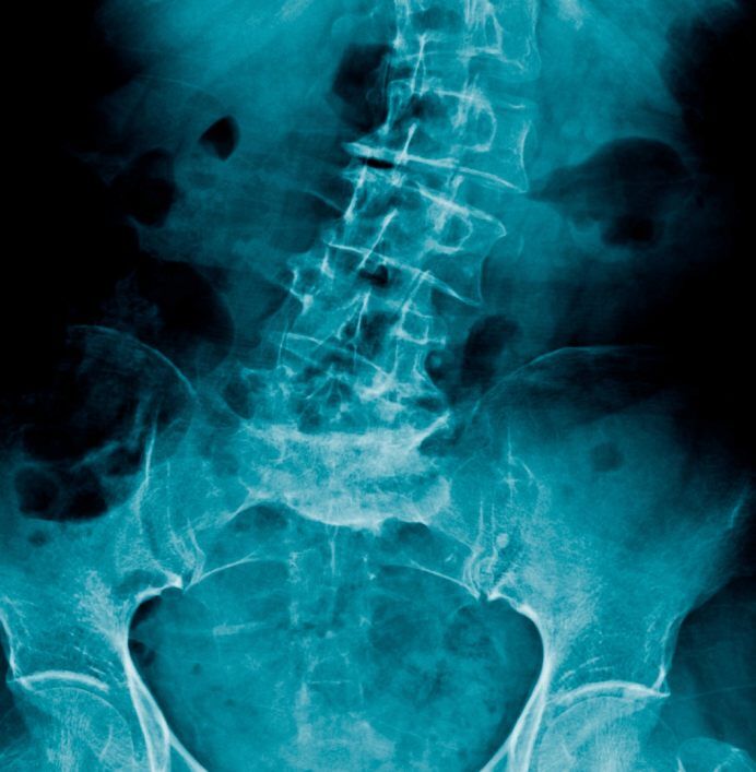 Lumbar Radiculopathy | Royal Spine Surgery